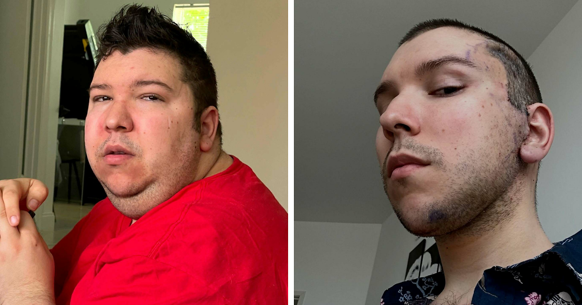 Nikocado Avocado Undergoes Cosmetic Surgery, Shares Results | Bored Panda